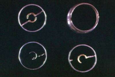 Anel de Ferrara™ - Ferrara Ring™ - Ferrara Ophthalmics