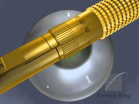 Anel de Ferrara™ - Ferrara Ring™ - Ferrara Ophthalmics